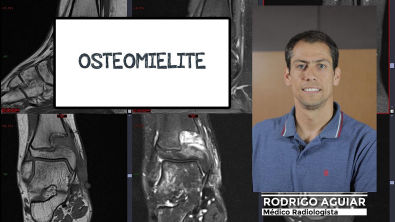 Osteomielite - Aspectos de Imagem - Patologia I