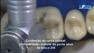 Vídeo: PREPARO CAVITÁRIO CLASSE I COMPOSTA (26) - Dentística