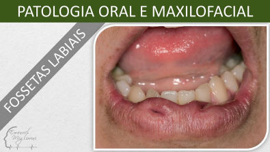 Fossetas Labiais - Patologia Oral e Maxilofacial - Estomatologia